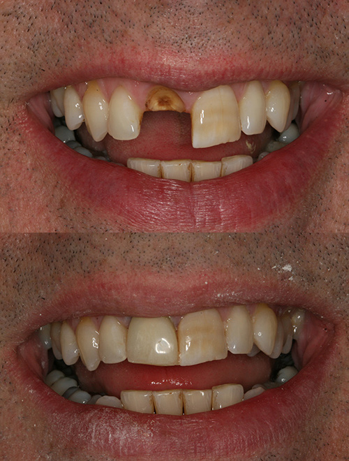 Patient Stories for Dental Implants | Bupa Dental Care