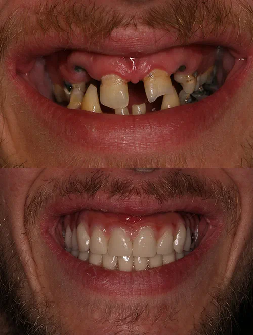 Patient Stories for Dental Implants | Bupa Dental Care