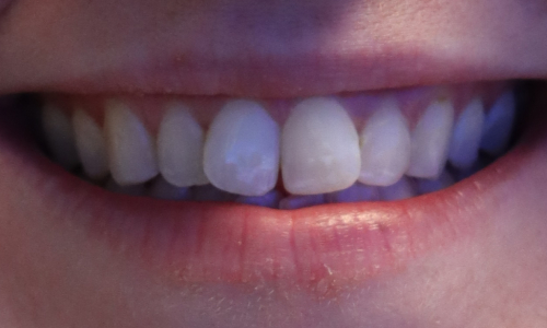 Before and Afters | Bupa Dental Care Cannock