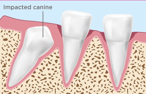 Impacted Canines | Impacted Teeth | Total Orthodontics